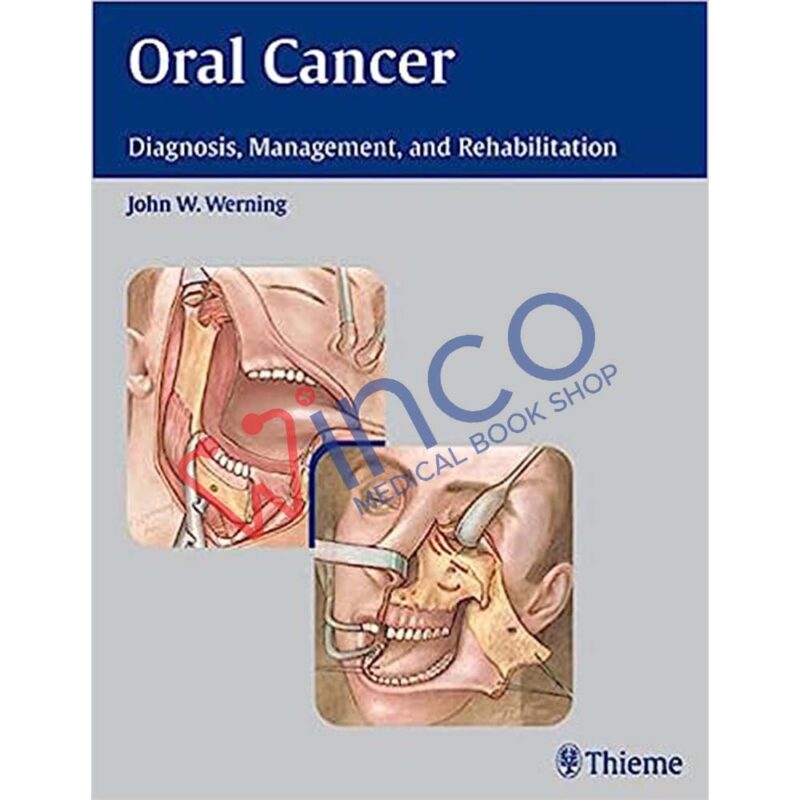 Oral Cancer: Diagnosis, Management, and Rehabilitation - Winco Medical ...